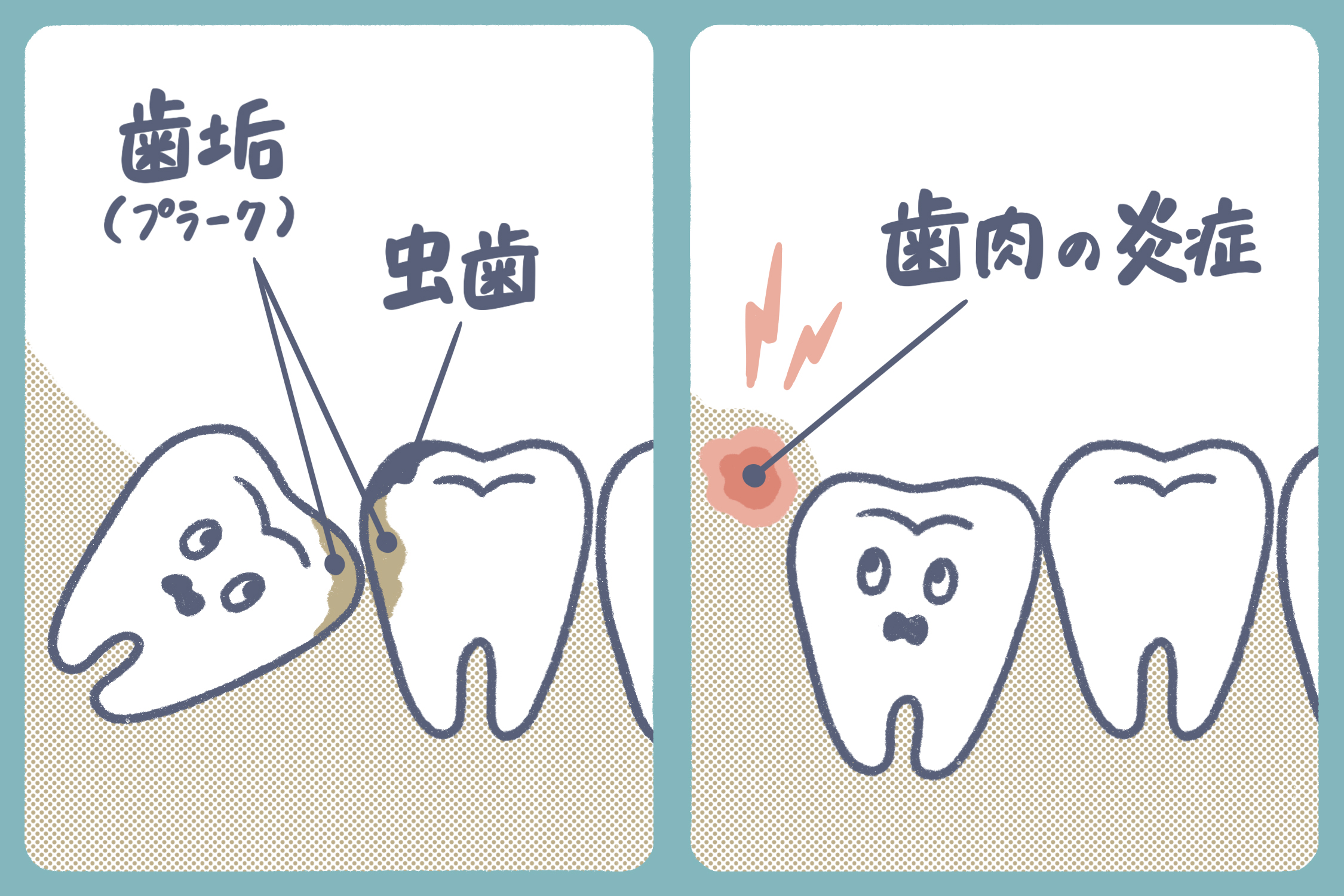【イラスト】親知らずによる虫歯や炎症…ツライ痛みトラブルをイラストで見る | kufura（クフラ）小学館公式